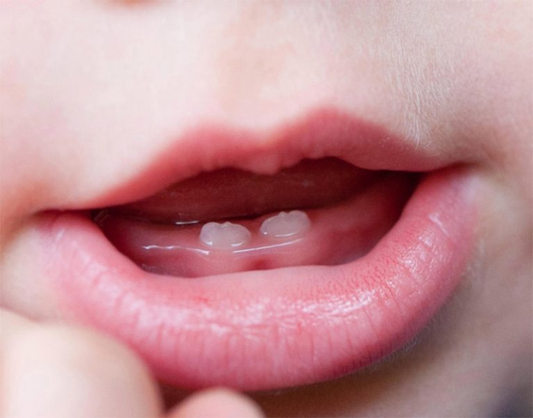 La dentizione decidua: sviluppo, funzioni e segnali dell’eruzione nei ...